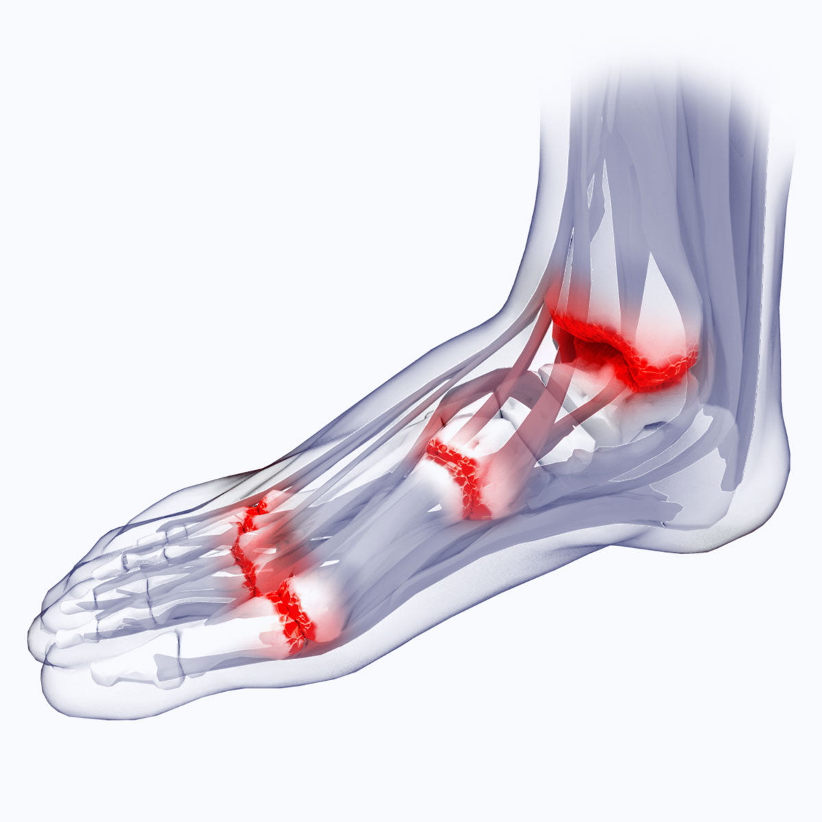 Arthritic Foot - Biopods Technologies - Biopods®