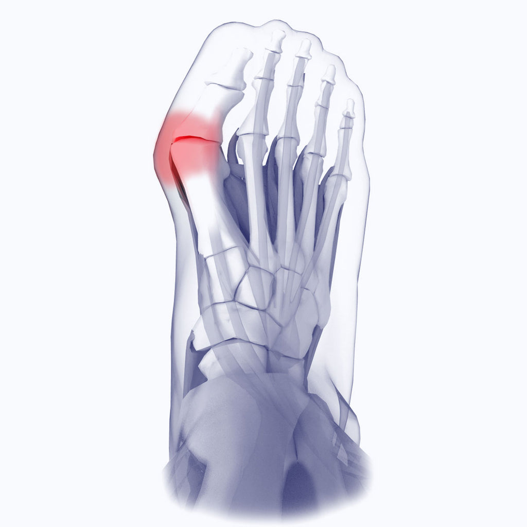 Bunions and Hallux Valgus - Biopods Technologies - Biopods®