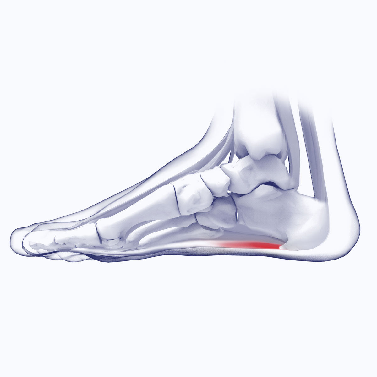 Heel Spurs - Biopods Technologies - Biopods®