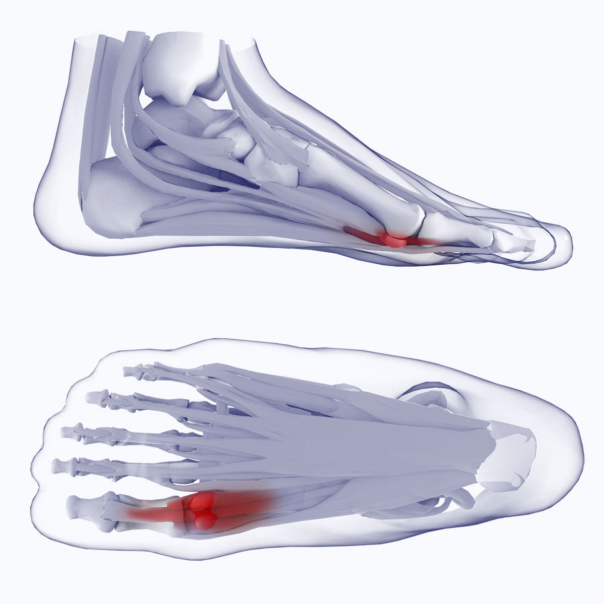 Sesamoiditis - - Biopods Technologies - Biopods®