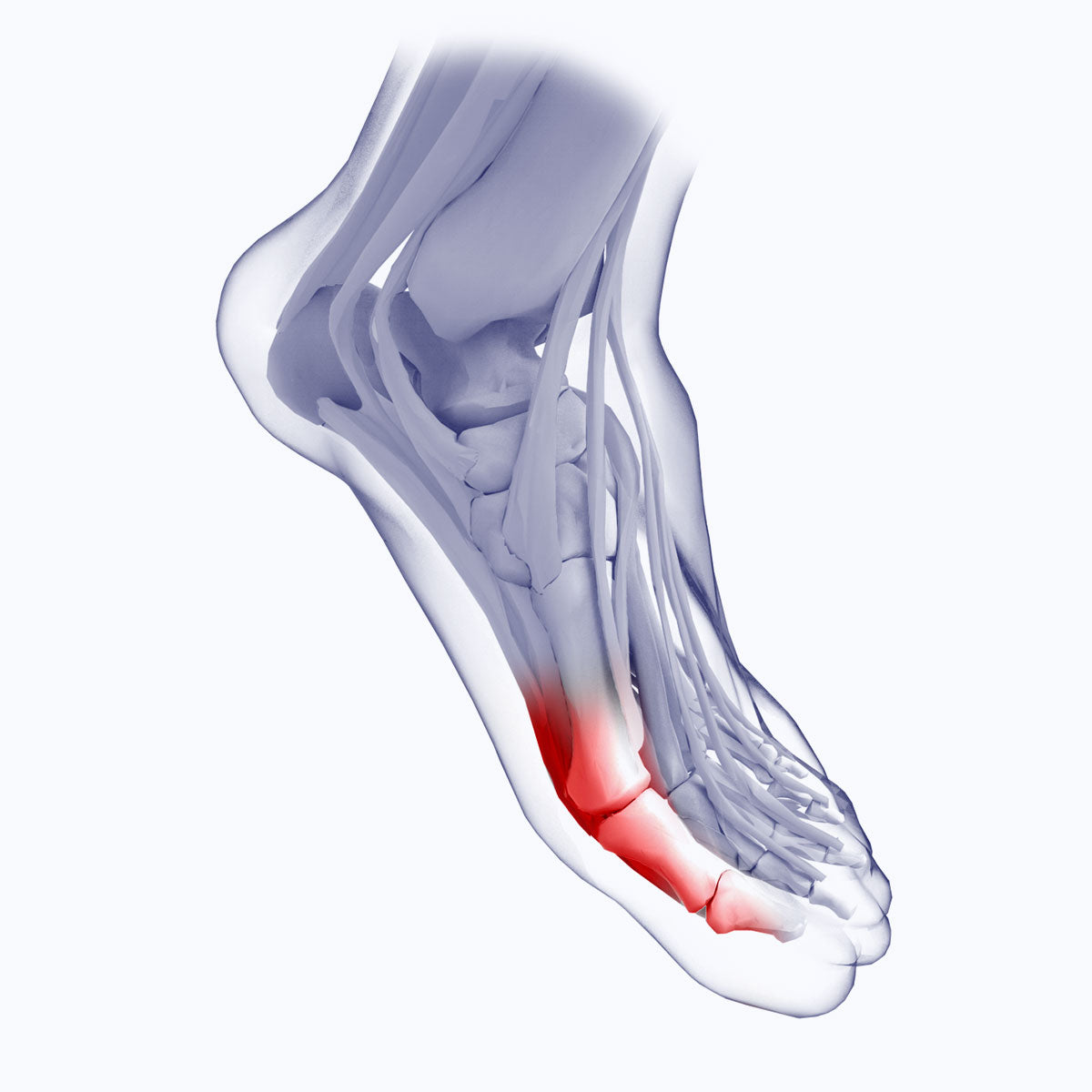 Turf Toe - Biopods Technologies - Biopods®